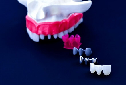 Dental Crowns | Sun City Dental El Paso, TX